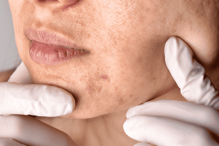 Is Menopause (or Perimenopause) Causing My Acne?